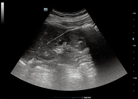 Wrist Msk Ultrasound Scan In Ballymena Private Health Scan