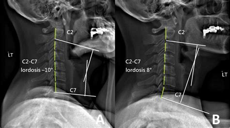 Cervical Alignment Comparison Using Sagittal Radiographs In Neutral