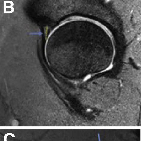 Magnetic Resonance Imaging Proton Density Sequence Demonstrating
