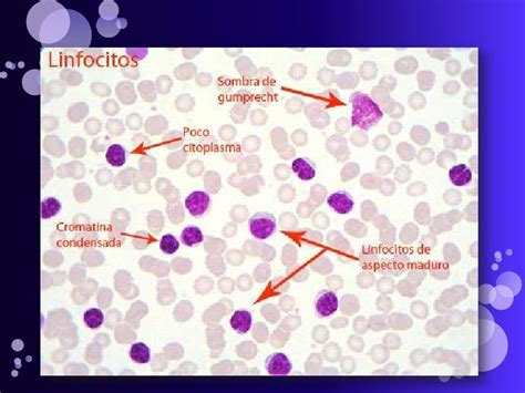 Leucemia Linfatica Cronica