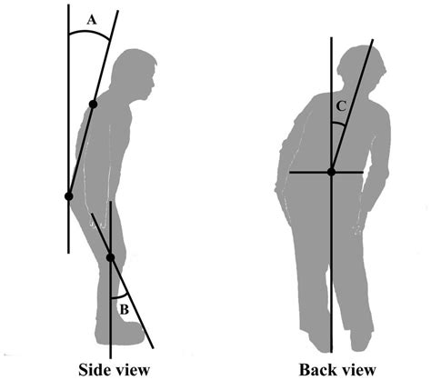 Measurements Of Postural Abnormality In Pd Evaluations Of Bent Spine Download Scientific