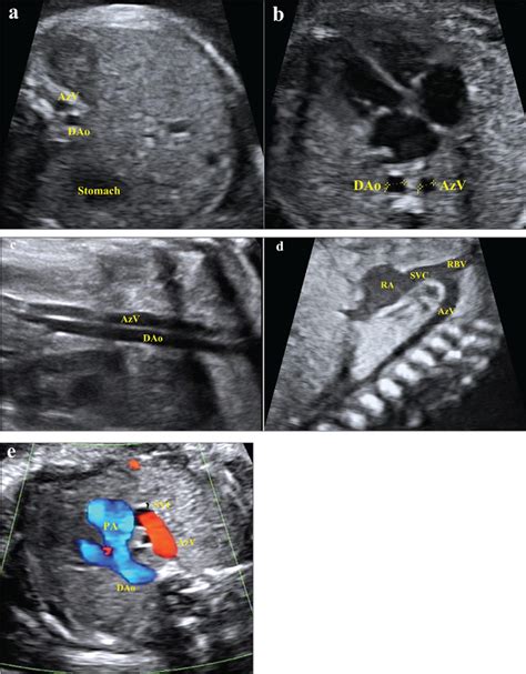 Catheter In Azygos Vein At Carolyn Wilson Blog