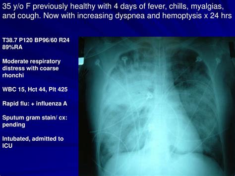 Ppt Outpatient And Inpatient Mrsa The New Idsa Guidelines Powerpoint