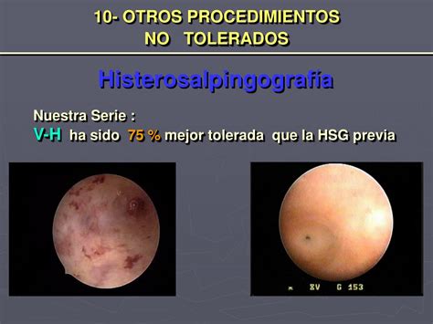 Ppt Avances En Histeroscopia Powerpoint Presentation Free Download