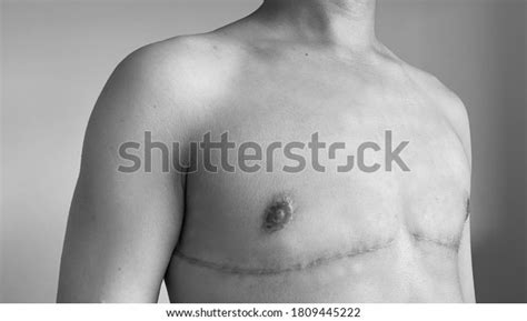 105 Chest Scar Removal Görseli Stok Fotoğraflar Ve Vektörler