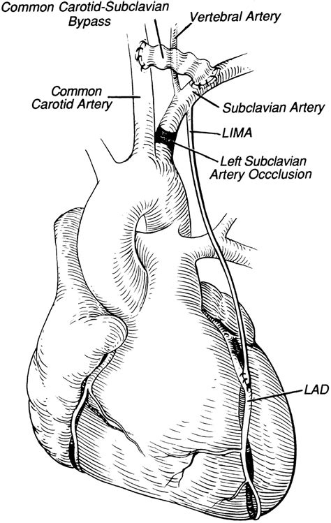 Coronary Artery Bypass Graft Surgery Of 77 Year Old Woman Circulation