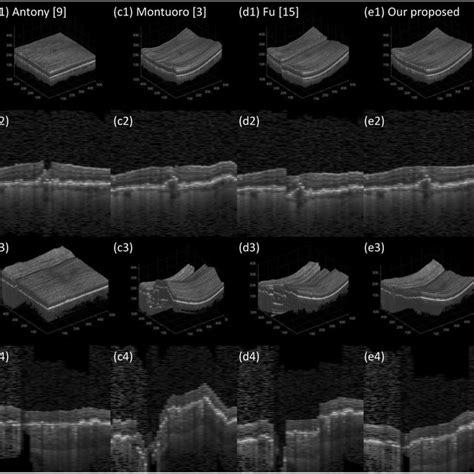 A 3d Oct Volume With Axial Motion Artifacts Indicated With Red