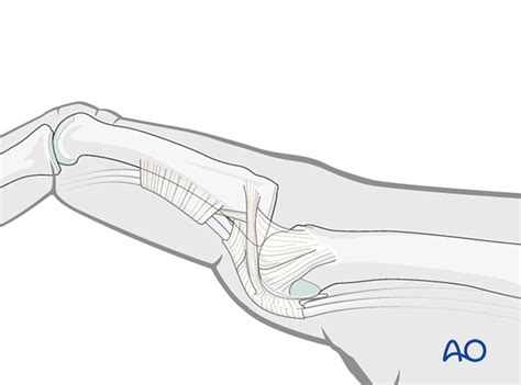 Orif For Dislocation And Fracture Dislocation Of The