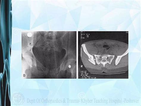 Pelvic Fracture Classification Pptx