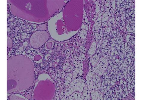 Ectopic Thyroid Tissue In Adrenal Gland A Case Report And Review Of Literature Open