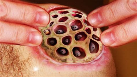 Trypophobia Is It Real Extended Edition Youtube