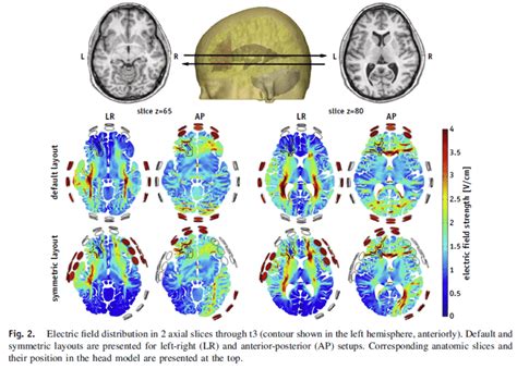 Electric Field Distribution In The Brain • Physics Forums