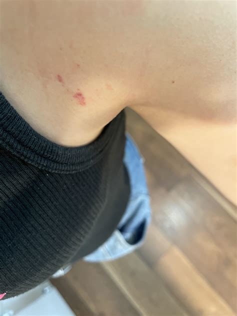 I 20m Just Had A Bunch Of Tiny Bumps Show Up All Over My Body R
