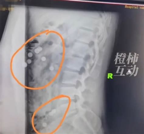 医生都懵了19岁小哥腰疼拍X光片子肠胃里全是 珍珠 知乎