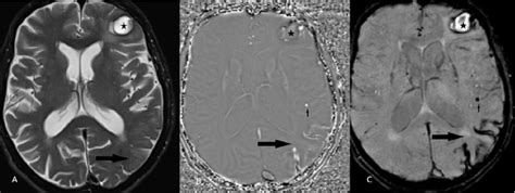 Display Axial T2 Fse A Phase B And Swi C Case With Cerebral