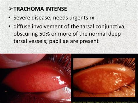Trachoma Pptx