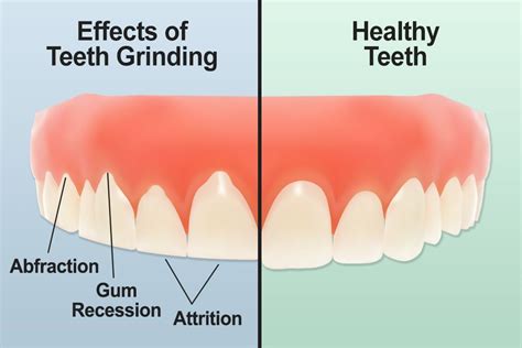 Do You Suffer From Bruxism Teeth Grinding Genesis Medical