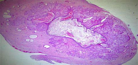 Endocervical Polyp With Florid “epidermal Metaplasia” Repor