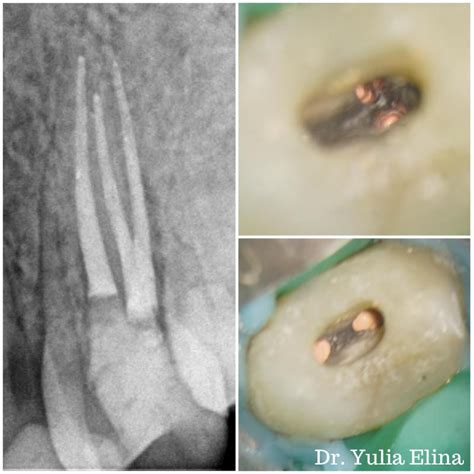 Dr Yulia Elina On Linkedin Microscopes Endo Dentalmicroscope Rct