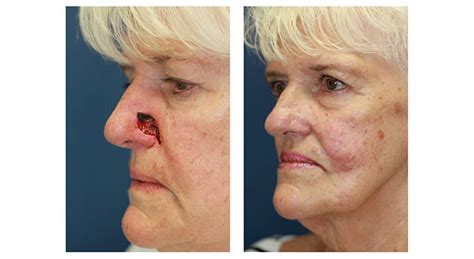 Facial Reconstruction Before And After Gallery Mount Sinai New York
