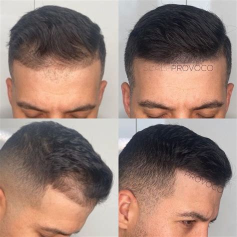 Scalp Micropigmentation Smp Hair Scalp Provoco Soho London Scalp Micropigmentation Smp Hair Scalp Provoco Soho London