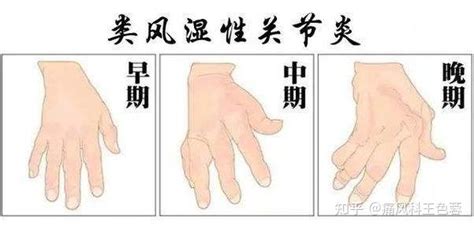 手指疼痛可能是这三种疾病在发信号 知乎