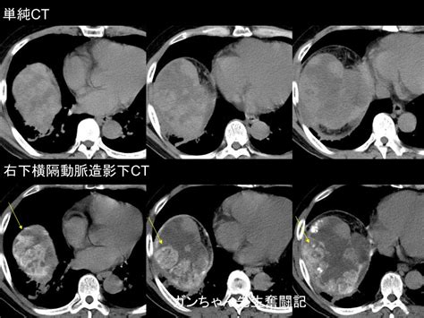 ガンちゃん先生奮闘記 安全にかつしっかりと 突出した肝臓がんに対する肝動脈化学塞栓術