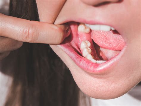 Dental Implants In Basildon From 33 25 Per Month