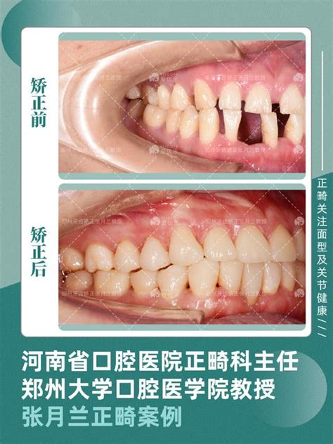 郑州正畸 郑州牙齿矫正 牙列稀疏问题的解决 知乎