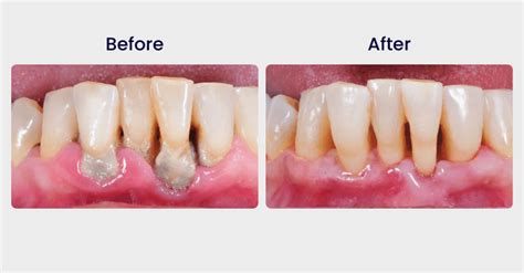 Periodontal Cleaning How It Differs From Regular Teeth Cleaning