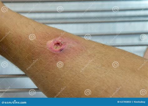Leg Abscess Wound Stock Image Image Of Illness Abscess 63785803