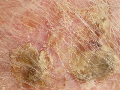 Scalp Rash Pustules At Isabella Clubbe Blog