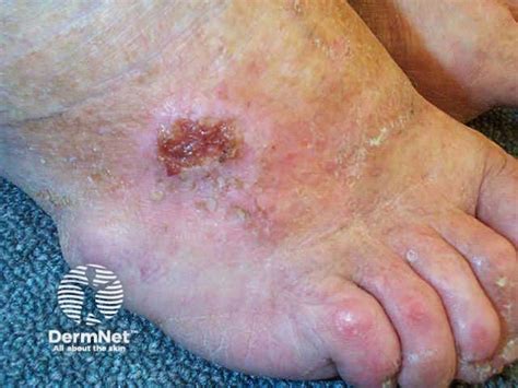 What Does Squamous Cell Carcinoma Look Like