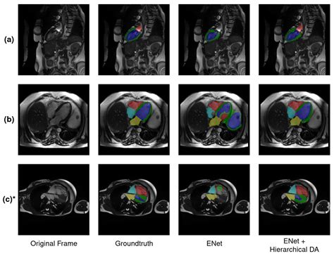 Effect Of Data Augmentation On Deep Learning Based Segmentation Of Long