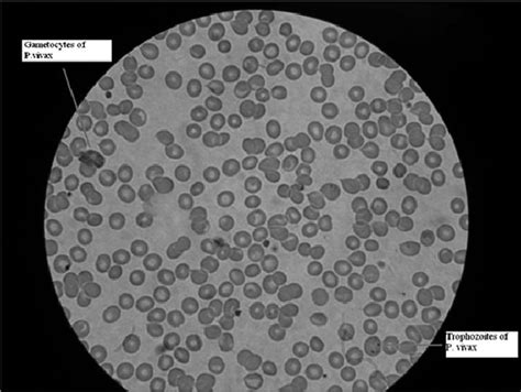 Note The Enlarged Red Cell With Ring Forms With Thin Lightly Stained Download Scientific