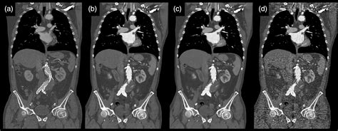 Evaluation Of An Iterative Modelbased Reconstruction Algorithm For Low