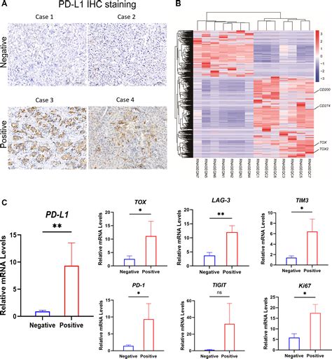 PD L1 Expression Is Linked To Tumor Infiltrating T Cell Exhaustion And