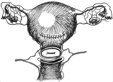 The Circumferential Tearing Of The Vaginal Vault Separating The Cervix