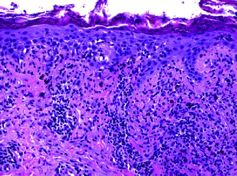 Erosion Basal Vacuolar Degeneration Dyskeratosis And Lichenoid