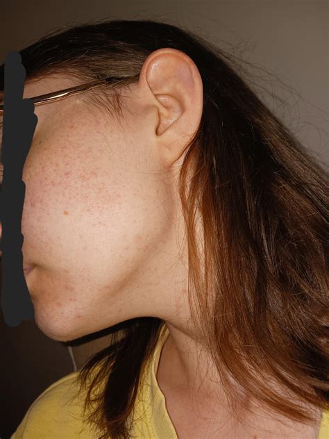 Ive Been Told By A Derm This Is Rosacea But Nothing Has Helped Any