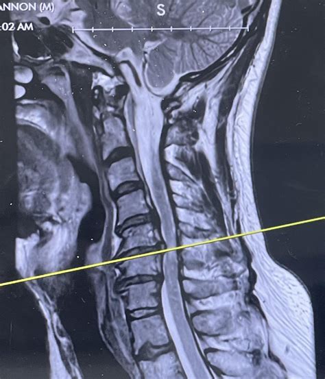 Best Spinal Surgery Option For Decompression At C5 C7 Rcervicalfusion