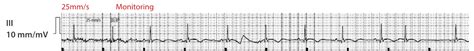 Case Observation Atrial Fibrillation With Rapid Ventricular Rate Alarm Mindray