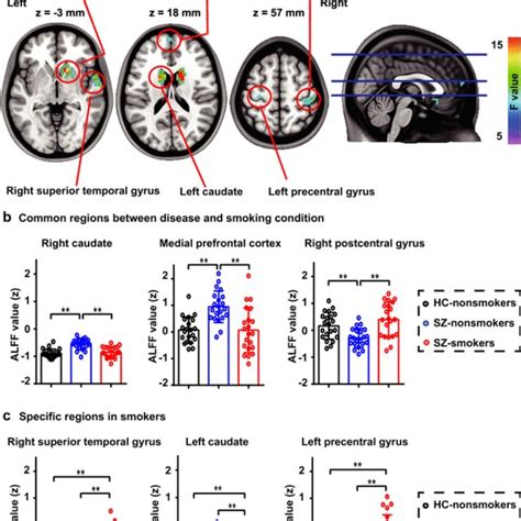 Statistical Analysis Of Brain Regions With Significant Differences In Download Scientific