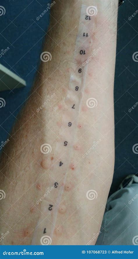 Manifestations Of An Allergic Reaction To The Sun Photodermatitis