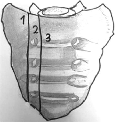 This Schematic Drawing Of The Sacrum Shows A Classification Of Sacral