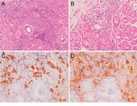 Figure From IgG Related Skin Lesions In A Patient With IgG Related Chronic Sclerosing
