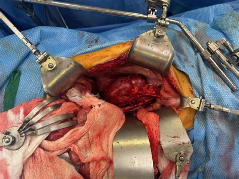 19 Year Old Sons Left Nephrectomy And Auto Renal Transplant Yesterdsy