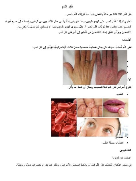 فقر الدم Pdf