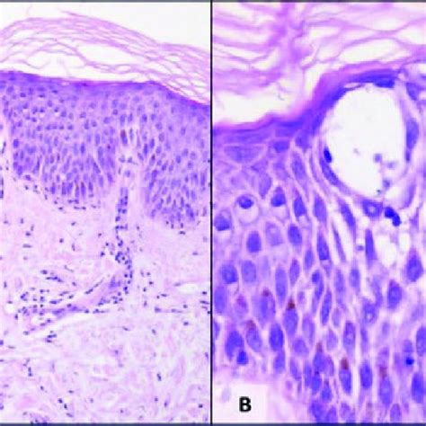 Drug Eruption And Histopathological Picture Mild Spongiosis In The