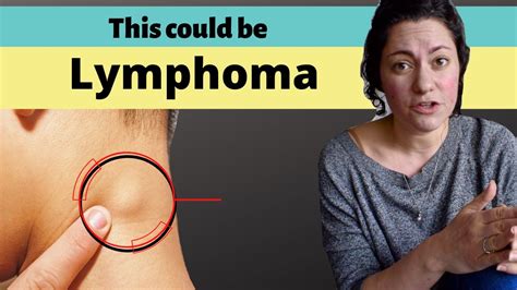 Do Swollen Lymph Nodes Feel Hot At Tahlia Loyau Blog